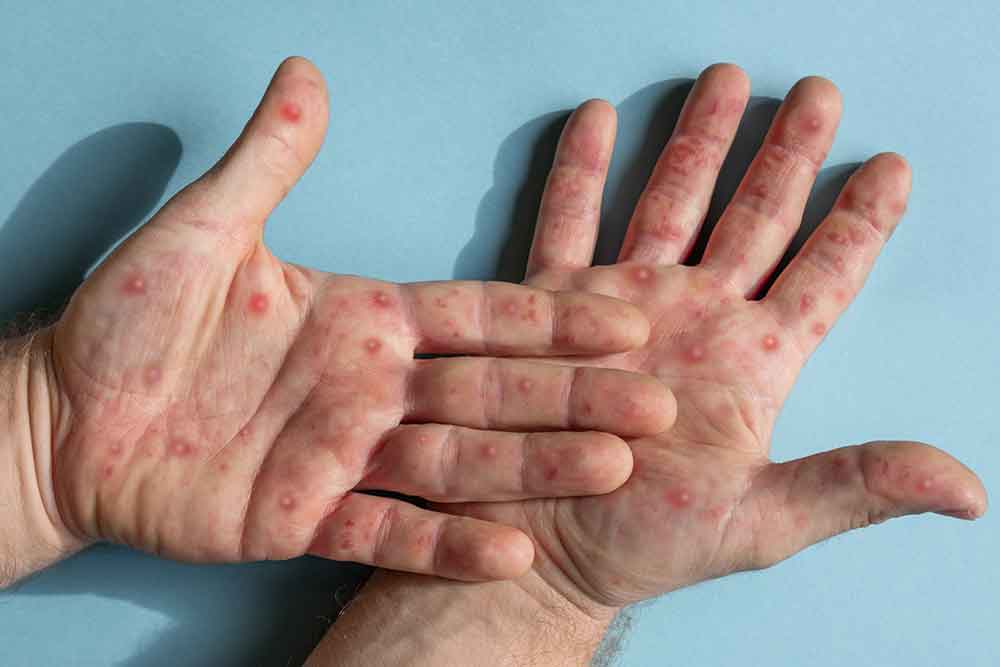 Monkeypox : Everything You Need to Know About Monkeypox